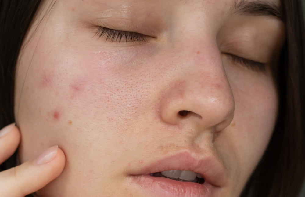 Clear the stigma around acne – One Fine Secret